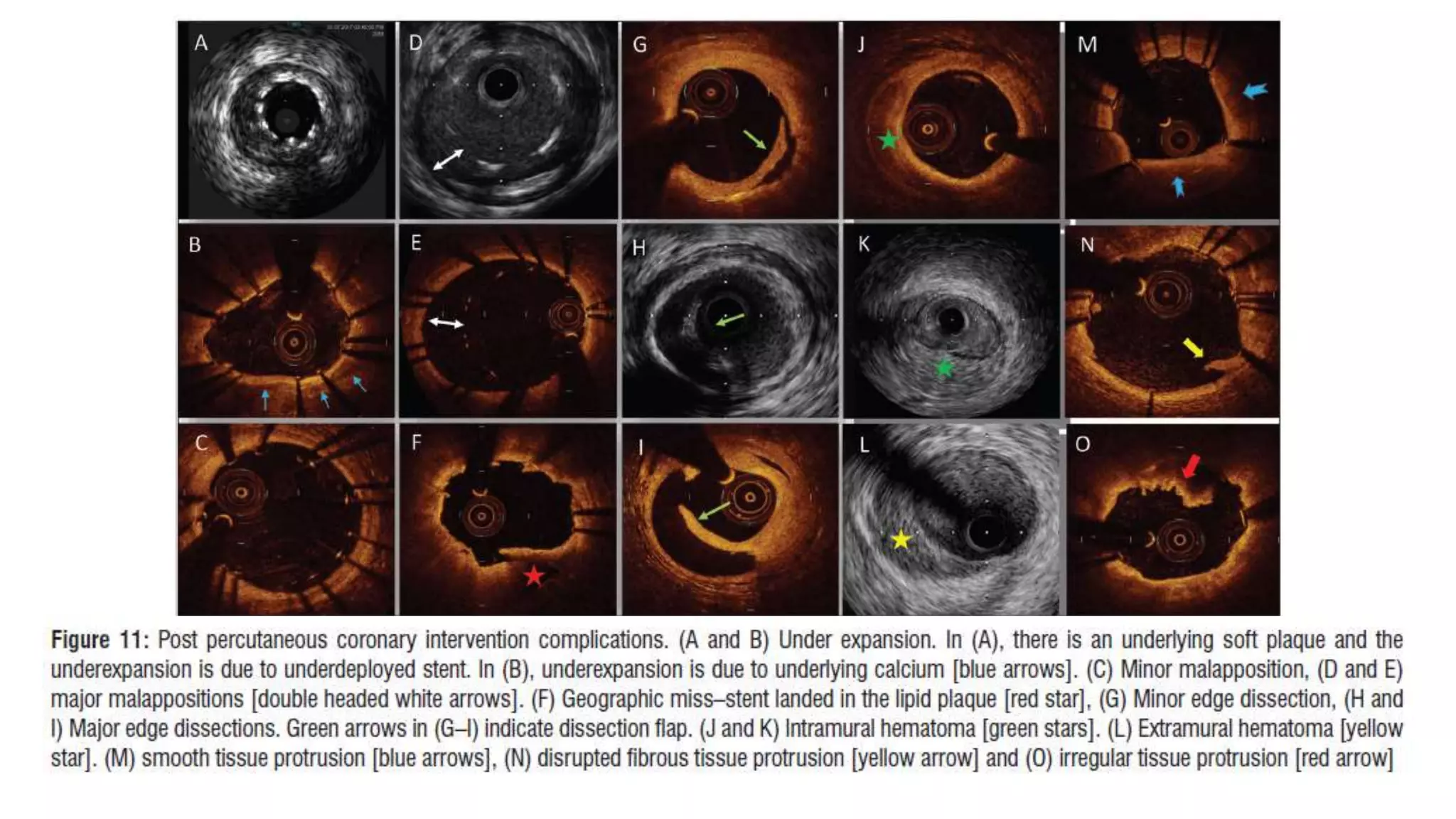 IVUS v/s OCT for Coronary Revascularization | PPTX