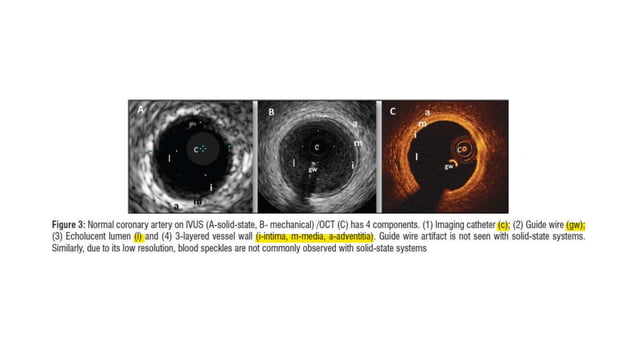 IVUS v/s OCT for Coronary Revascularization | PPTX