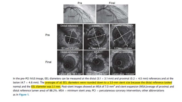 IVUS v/s OCT for Coronary Revascularization | PPTX