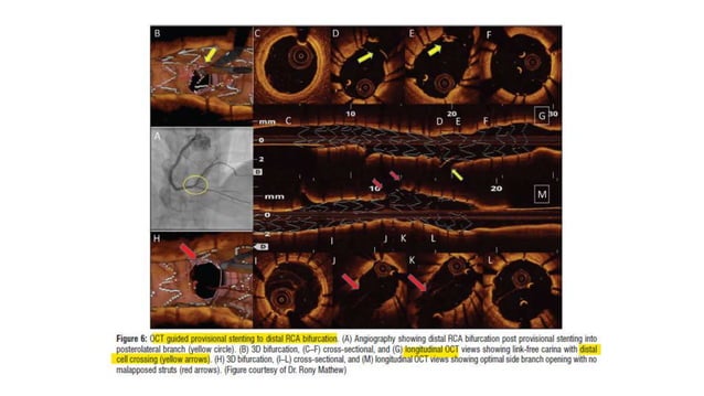 IVUS v/s OCT for Coronary Revascularization | PPTX