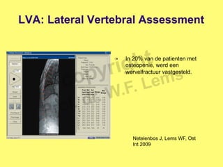 Hoe wervelfracturen te diagnosticeren | PPT