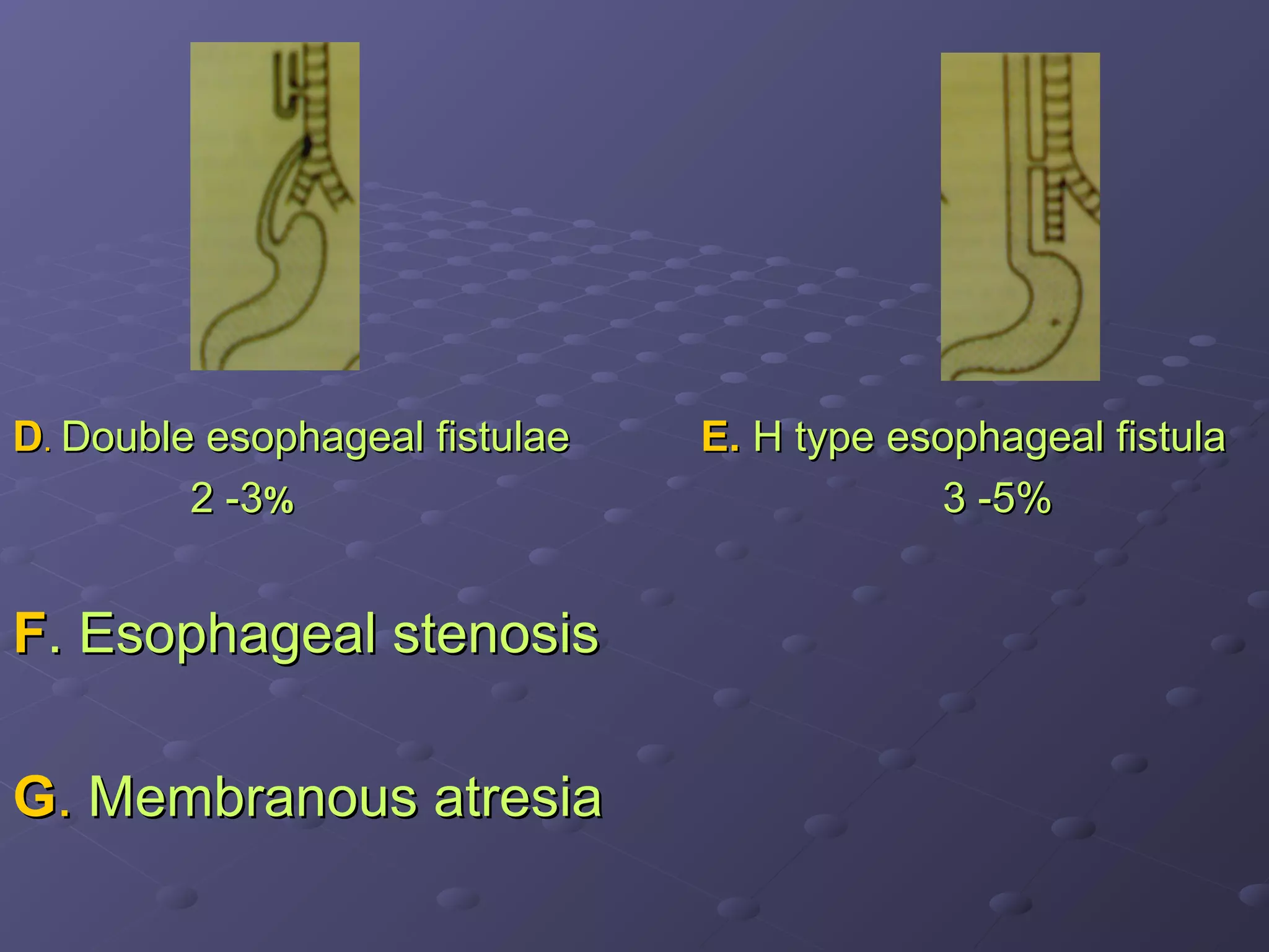 Tracheo esophageal fistula | PPT