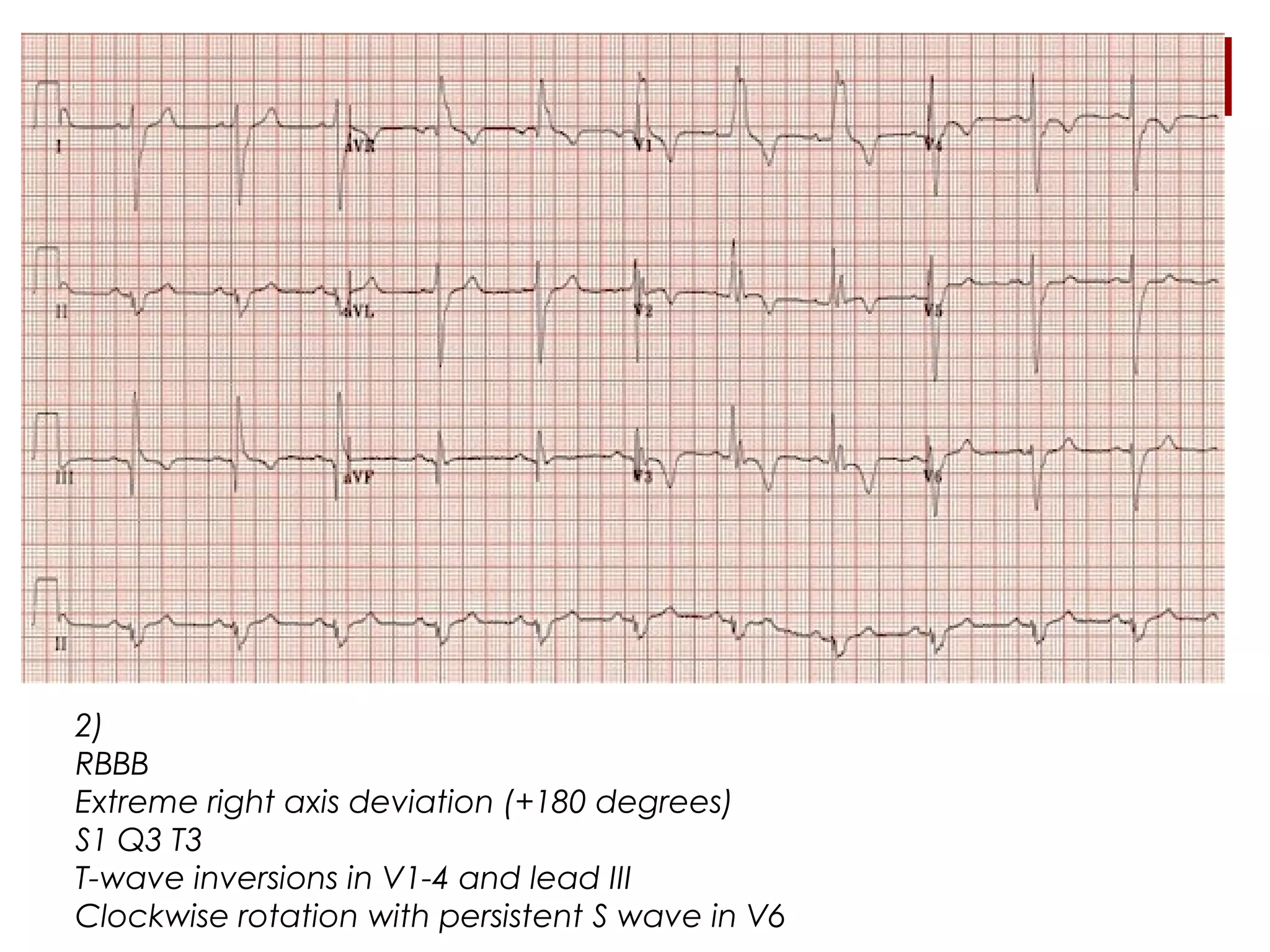 Investigation of suspected pulmonary embolism in pregnancy | PPT