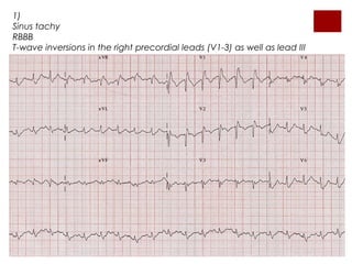 Investigation of suspected pulmonary embolism in pregnancy | PPT