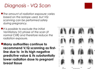 Investigation of suspected pulmonary embolism in pregnancy | PPT