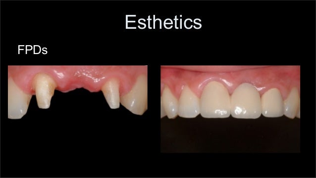 The Dilemma of The Missing Anterior Single Tooth - Restorative Parame…