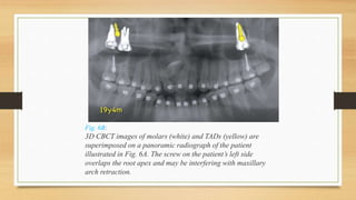 Izc screw by mahadia SAAD ALLAFY | PPTX