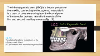 Izc screw by mahadia SAAD ALLAFY | PPTX | Dental Health | Diseases and ...