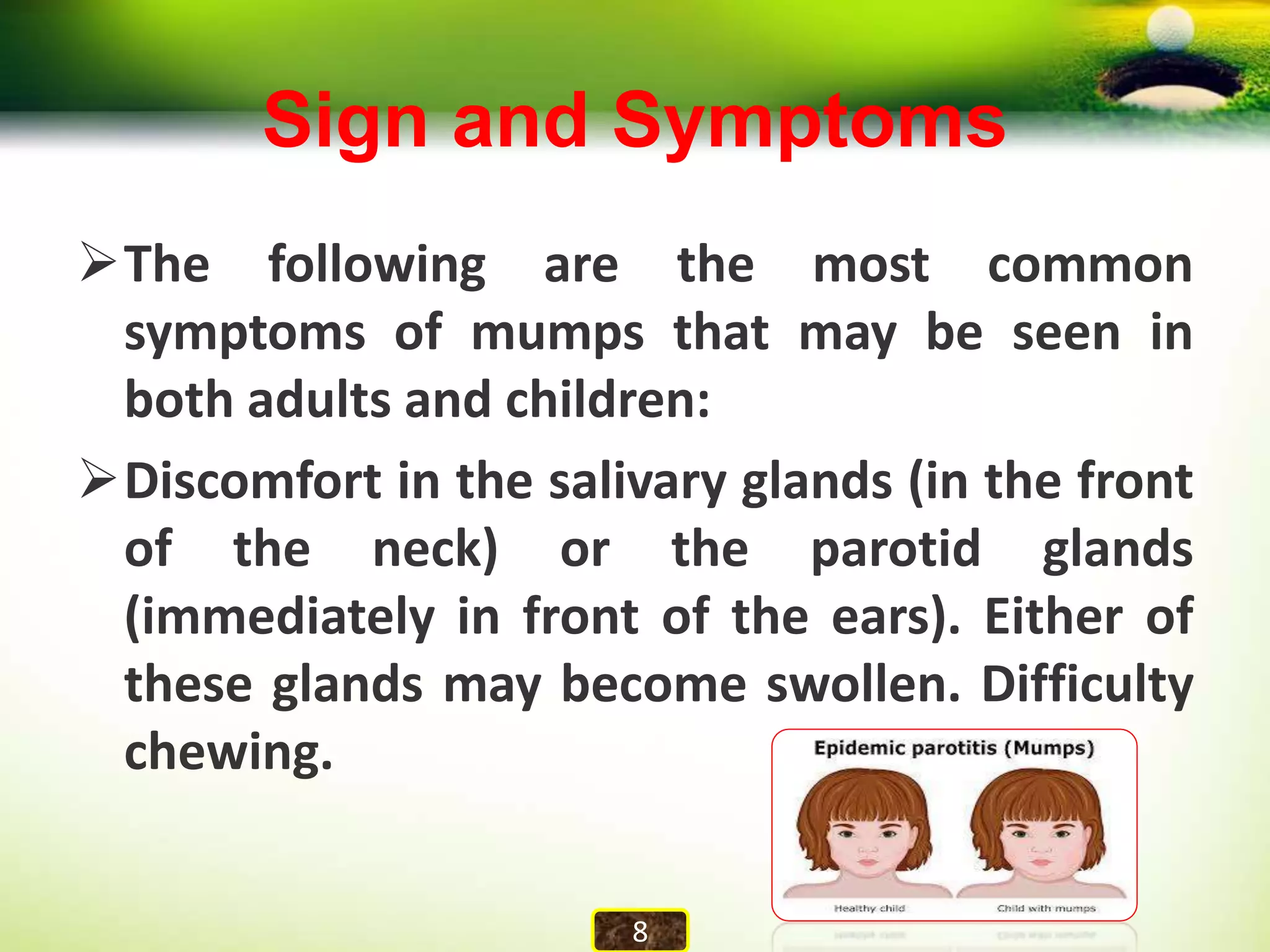 Izzatullah presentation mumps virus | PPTX