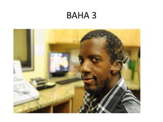 BAHA | PPT