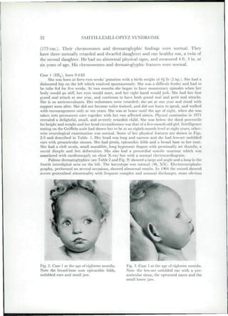 Smith-Lemli-Opitz Syndrome3 | PDF | Genetics | Science