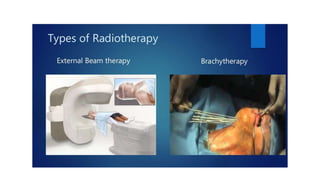 RADIOTHERAPY MANAGEMENT OF ORAL CANCER | PPTX