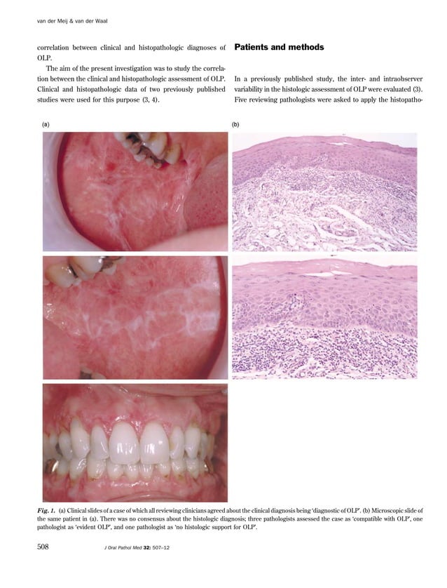 how to make proper dignosis of oral lichen planus | PDF