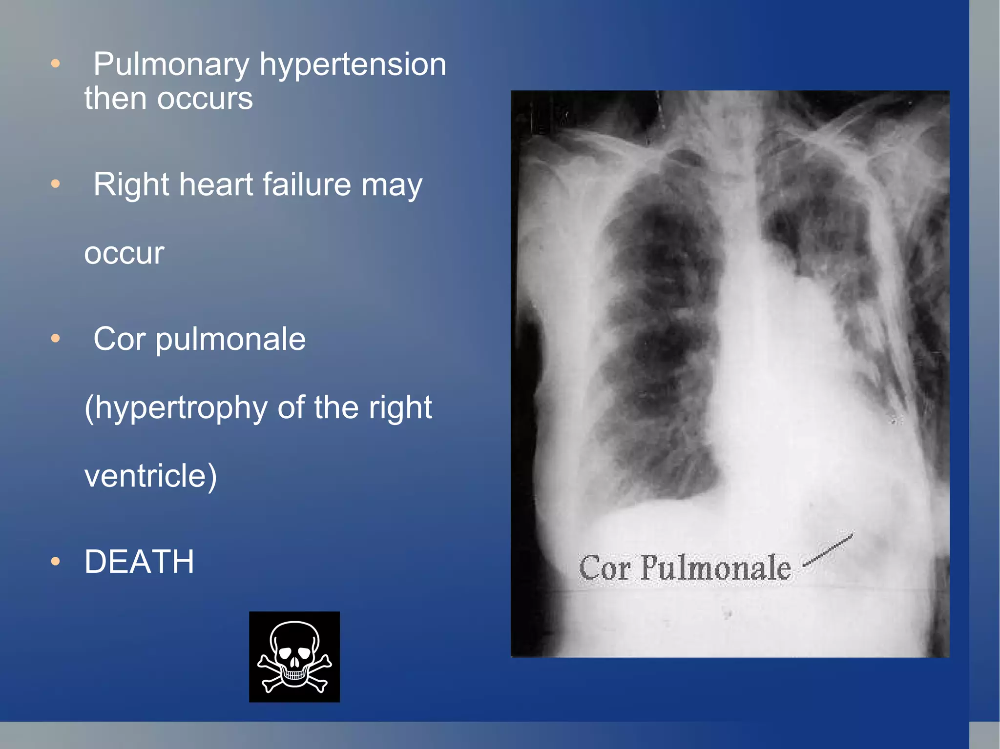 J. Parker Emphysema Presentation Powerpoint | PPT
