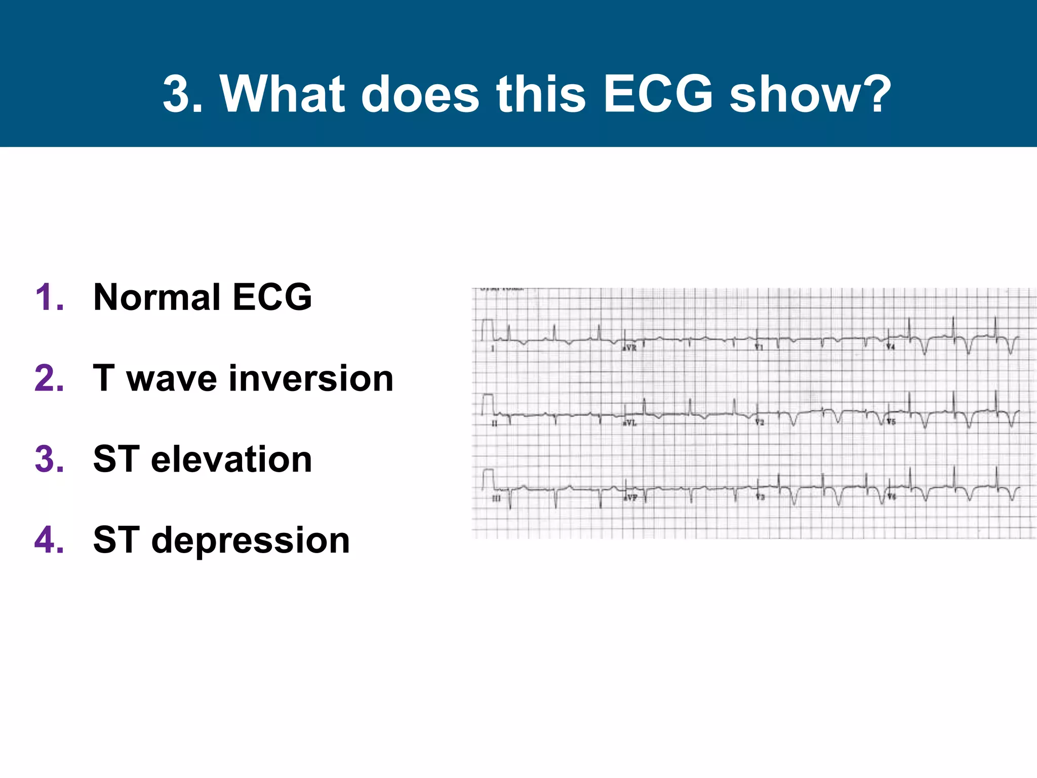 ECG interpretation: NSTEMI | PPTX | Heart and Cardiovascular Diseases ...