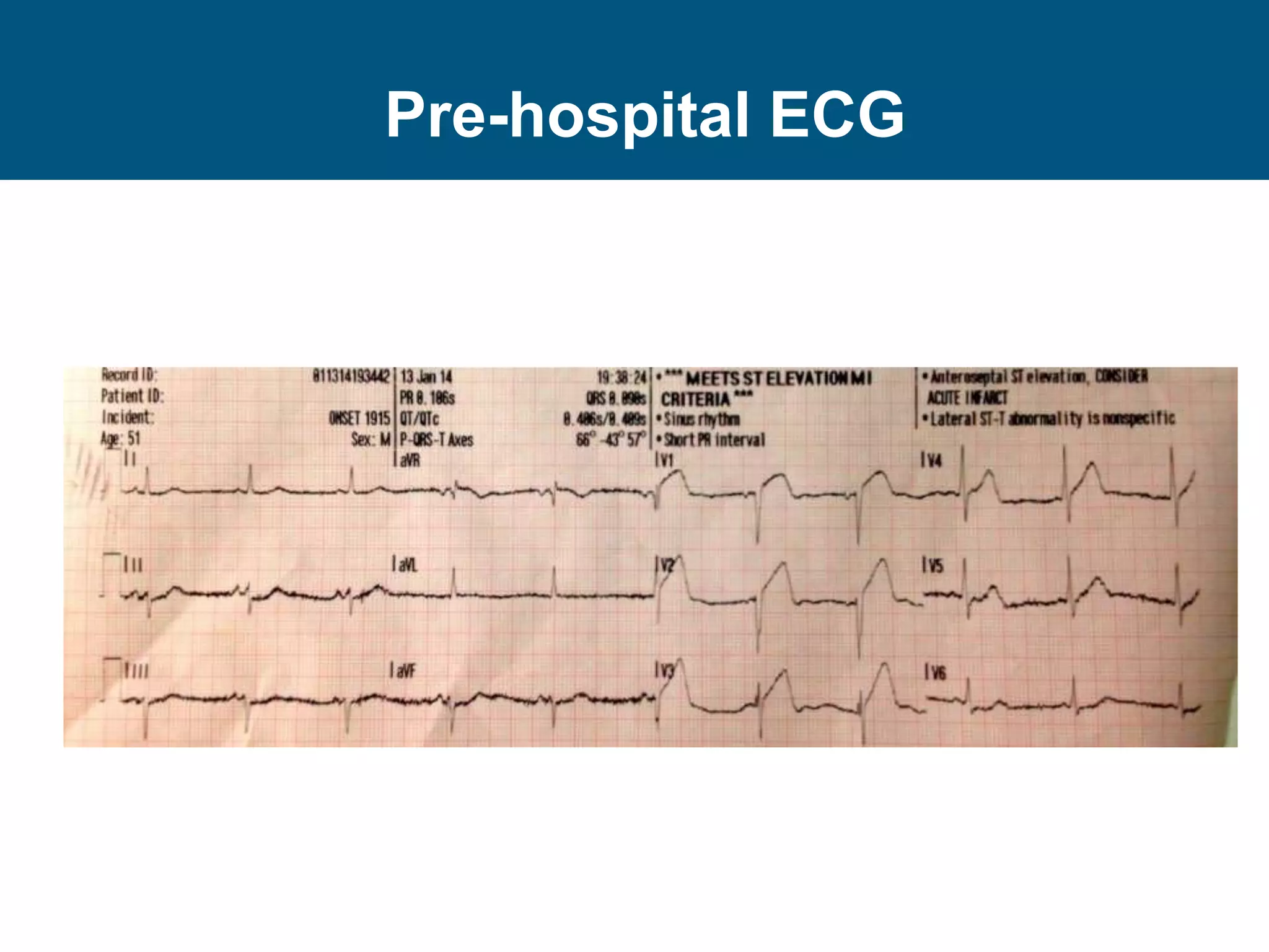 ECG interpretation: NSTEMI | PPTX