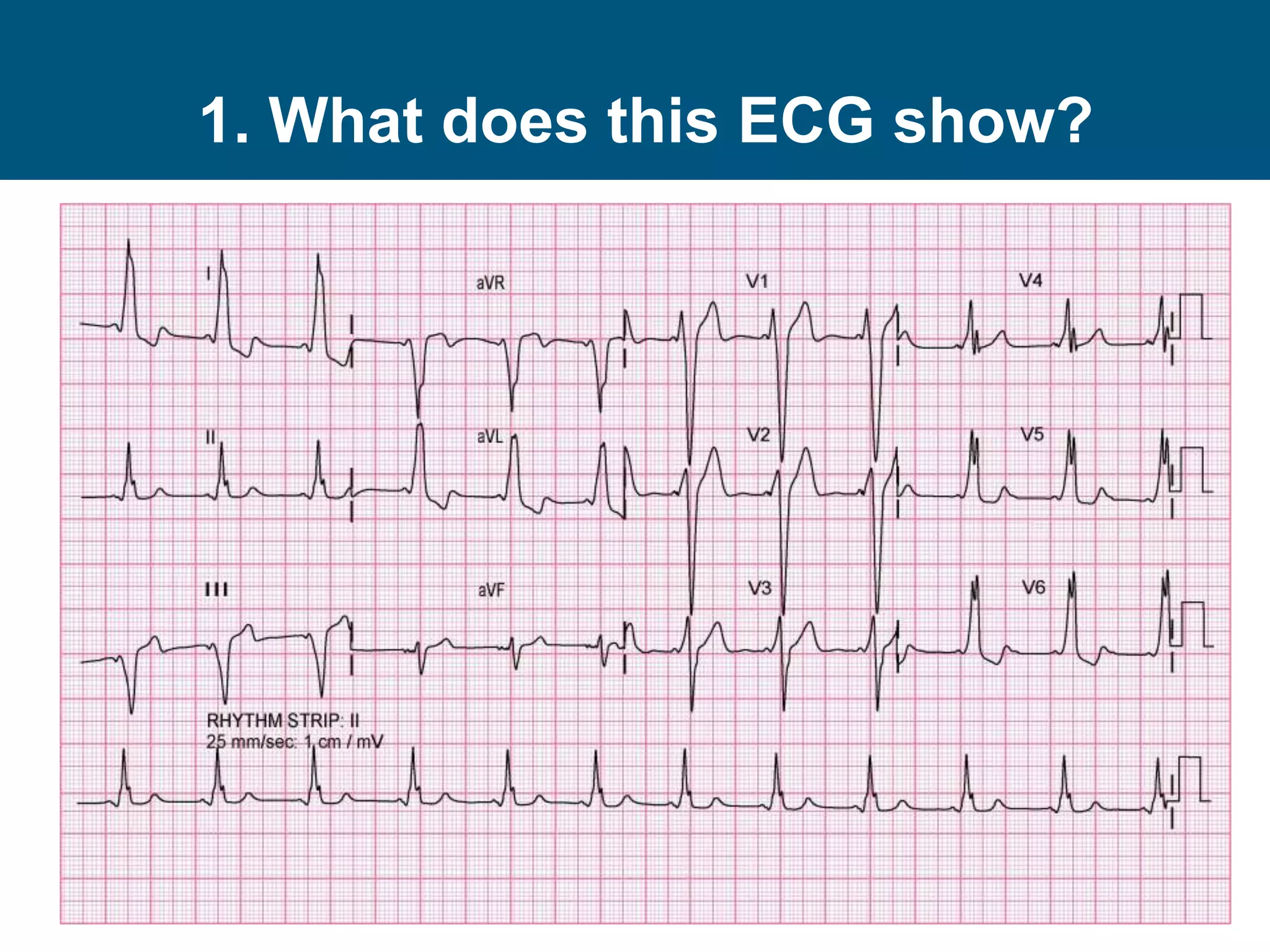 ECG interpretation: NSTEMI | PPTX