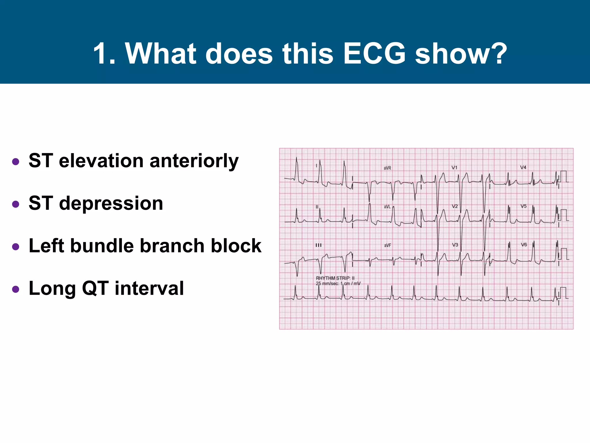 ECG interpretation: NSTEMI | PPTX