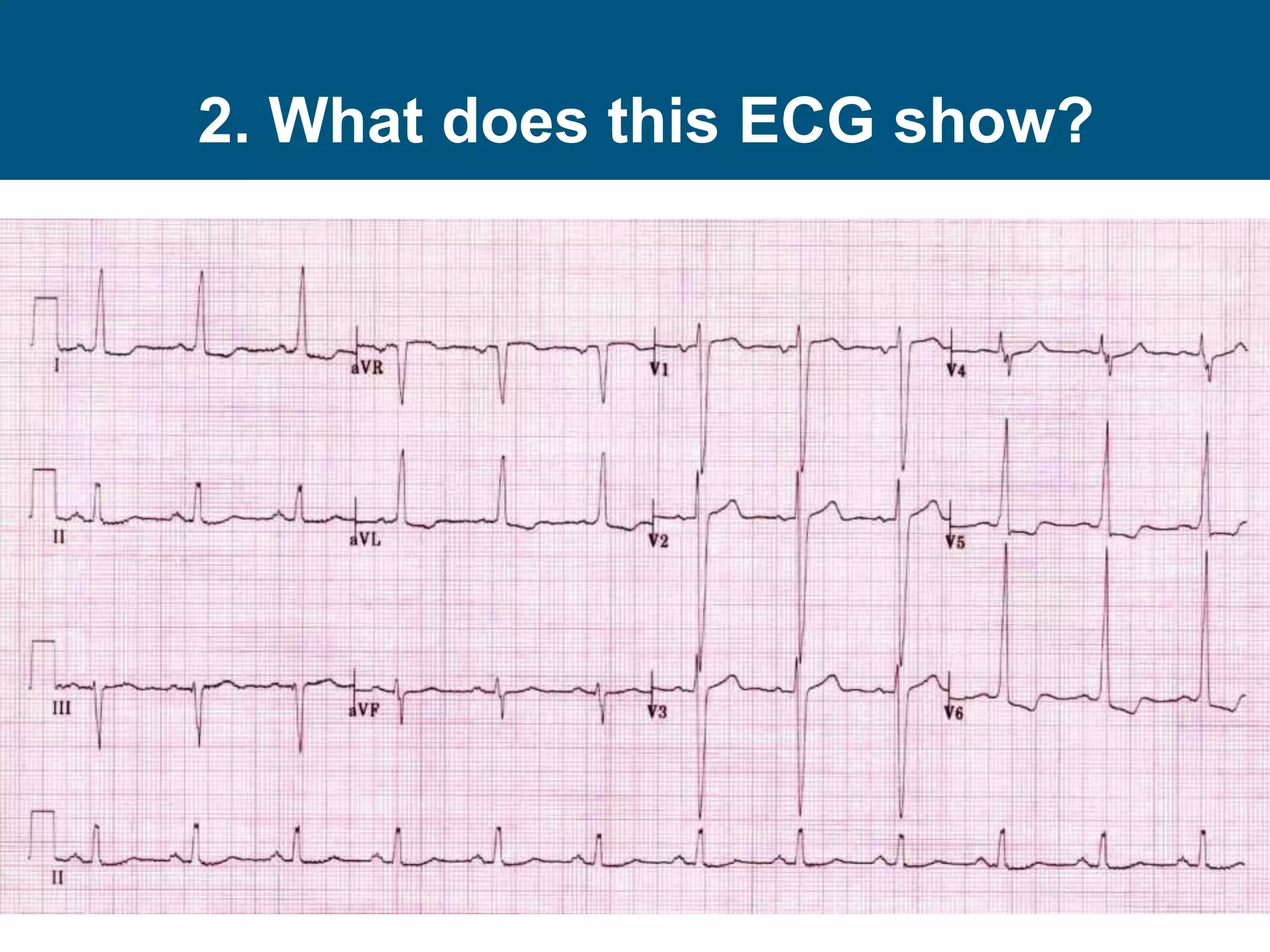 ECG interpretation: NSTEMI | PPTX