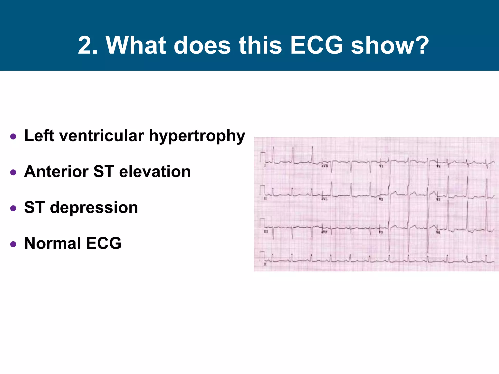 ECG interpretation: NSTEMI | PPTX