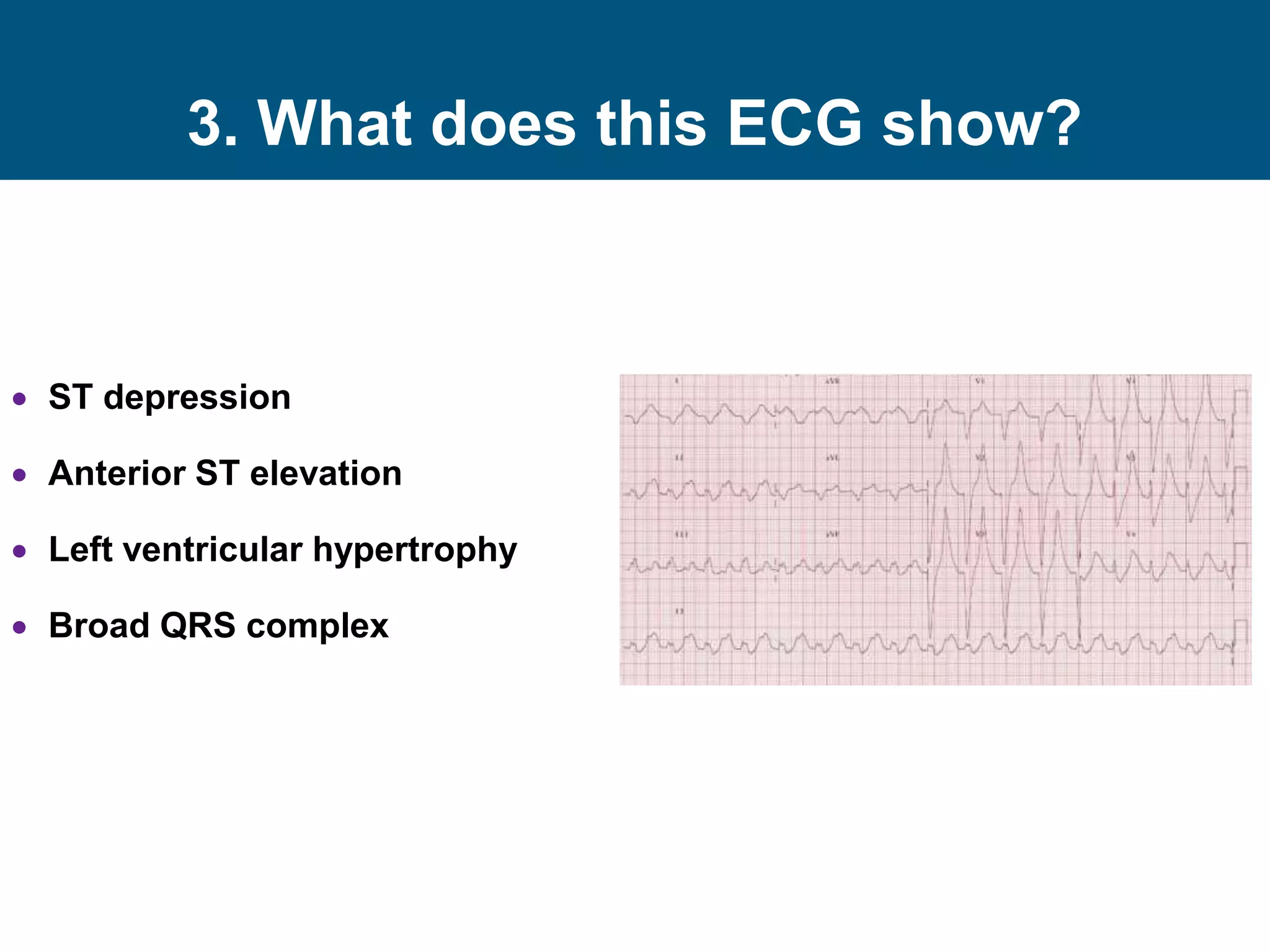 ECG interpretation: NSTEMI | PPTX