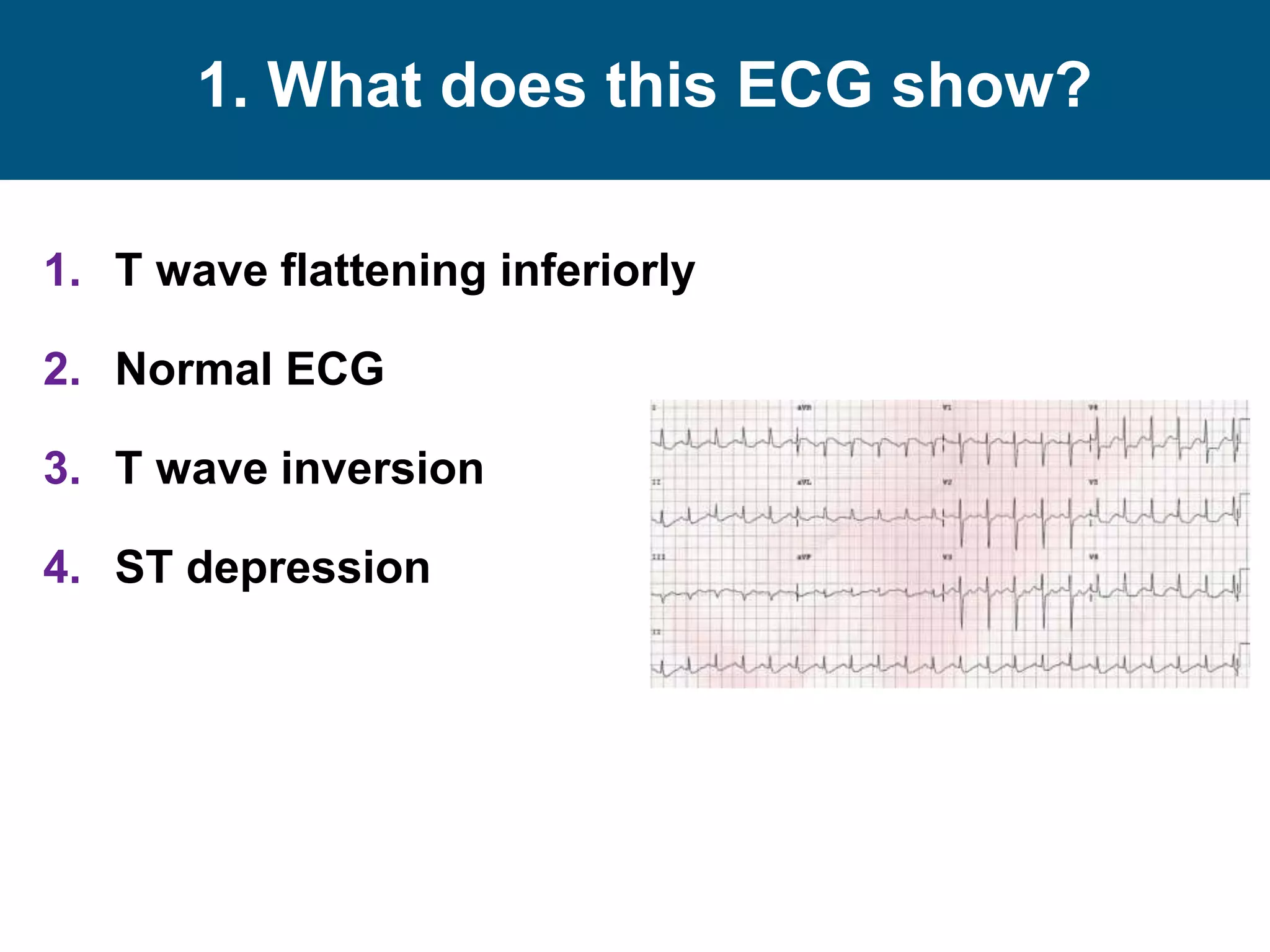 ECG interpretation: NSTEMI | PPTX
