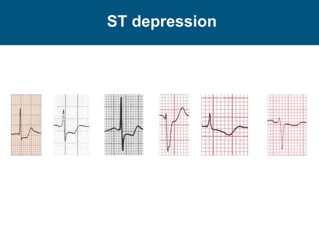 ECG interpretation: NSTEMI | PPTX | Heart and Cardiovascular Diseases ...