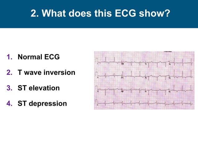 ECG interpretation: NSTEMI | PPTX | Heart and Cardiovascular Diseases ...