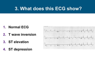 ECG interpretation: NSTEMI | PPTX