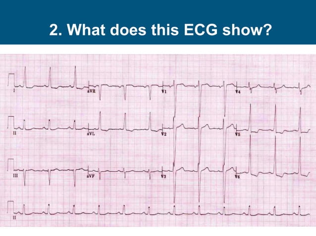 ECG interpretation: NSTEMI | PPTX | Heart and Cardiovascular Diseases ...