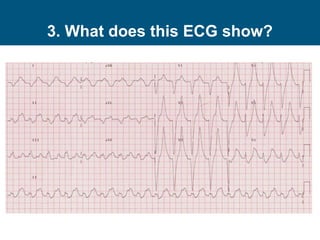 ECG interpretation: NSTEMI | PPTX