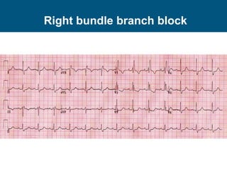 ECG interpretation: NSTEMI | PPTX