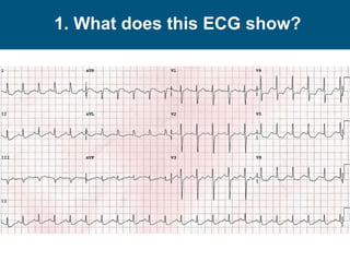 ECG interpretation: NSTEMI | PPTX