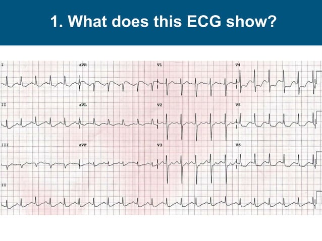 ECG interpretation: NSTEMI | PPTX | Heart and Cardiovascular Diseases ...