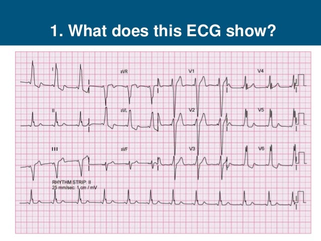 ECG interpretation: NSTEMI