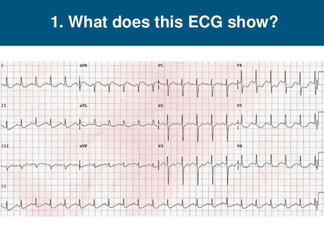 ECG interpretation: NSTEMI