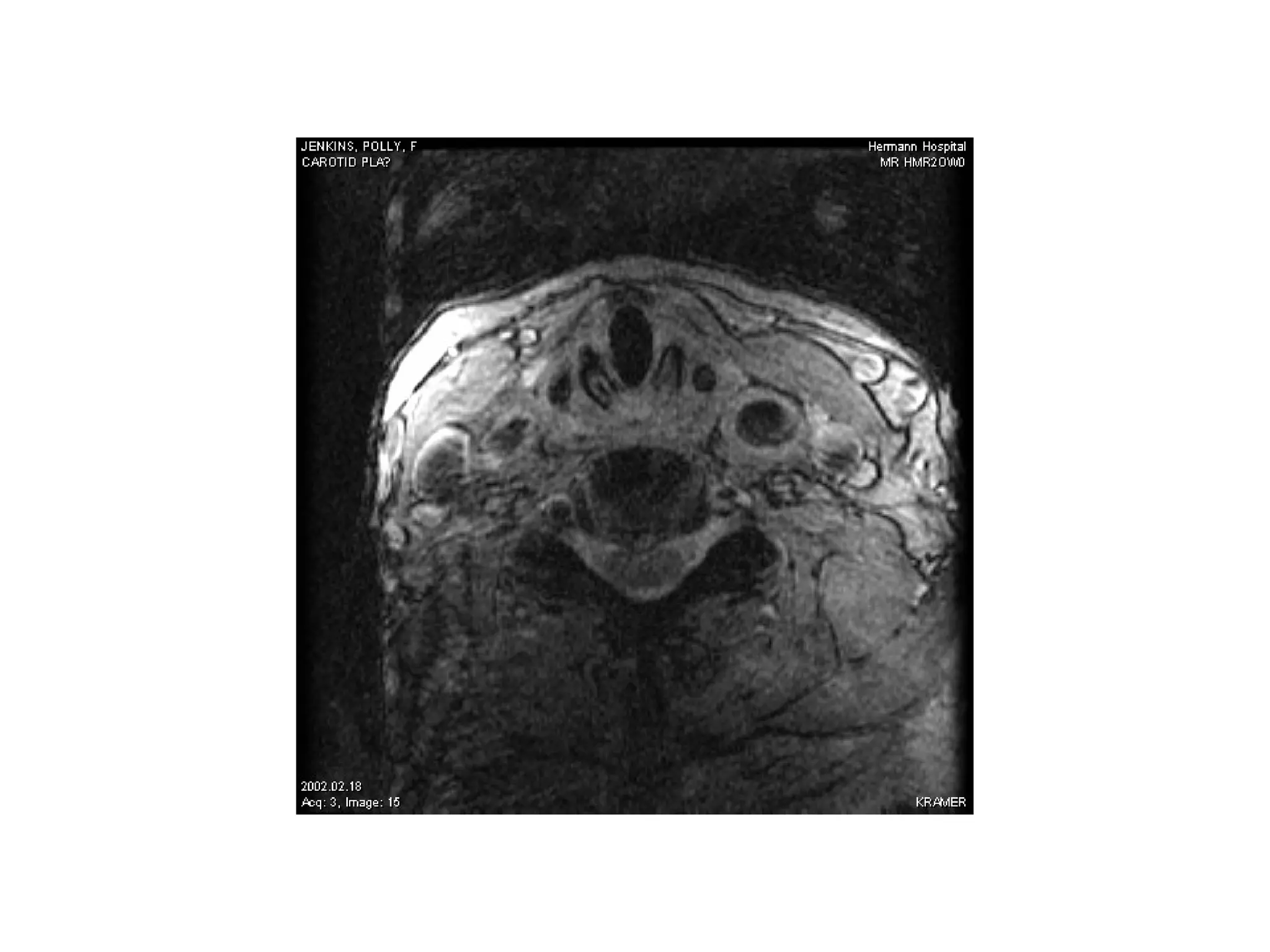 096 mri imaging of atherosclerosis using spio | PPT