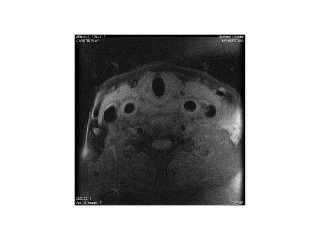 096 mri imaging of atherosclerosis using spio | PPT