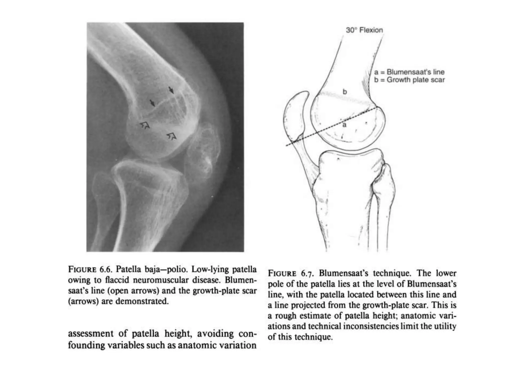 Patella dislocations | PPTX