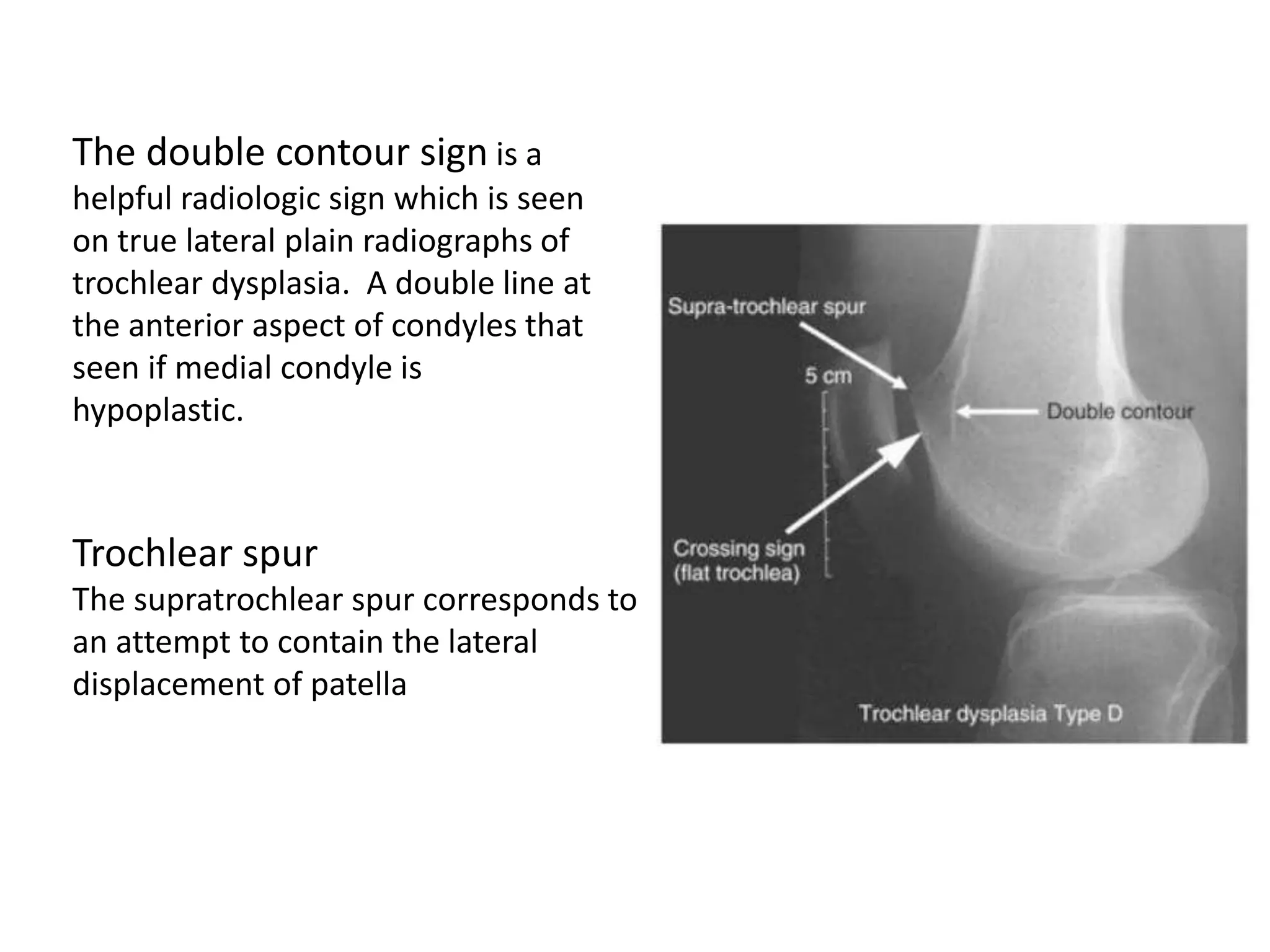 Patella dislocations | PPTX