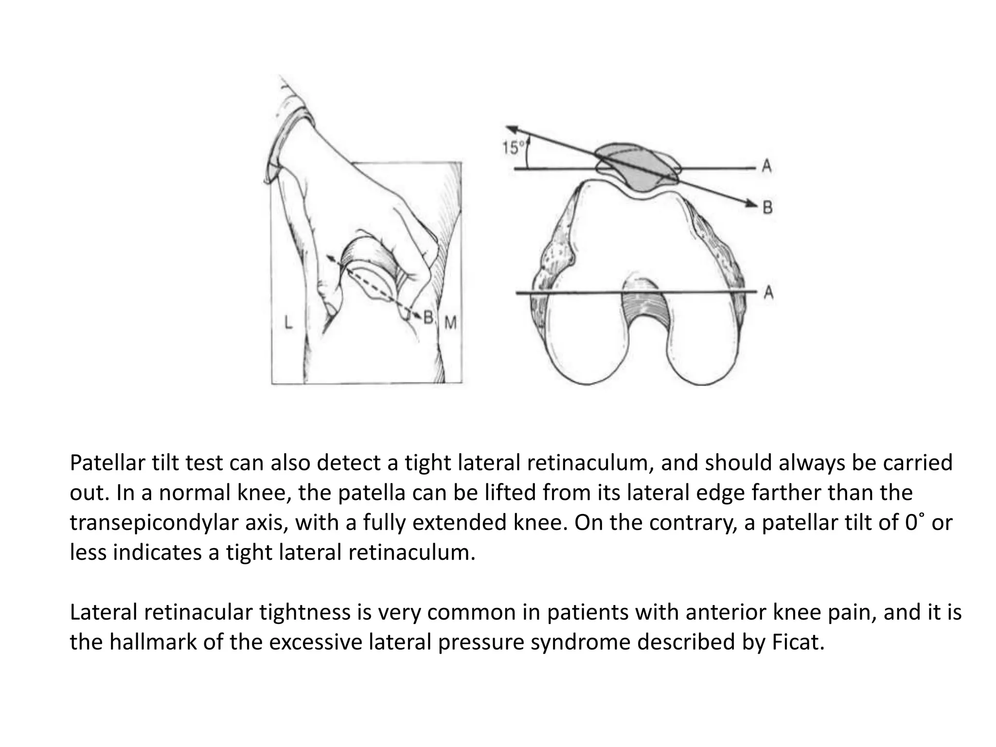 Patella dislocations | PPTX