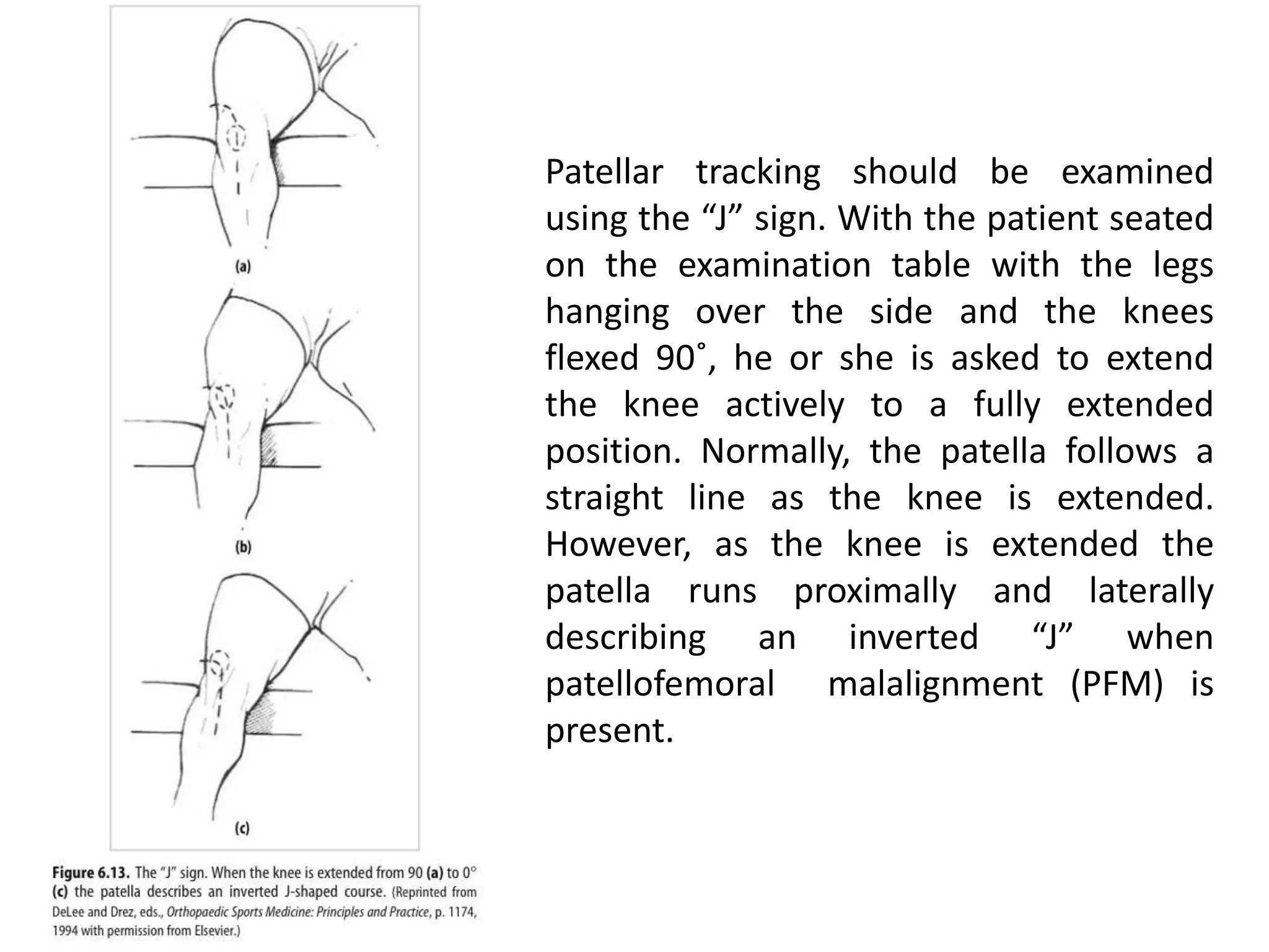 Patella dislocations | PPTX