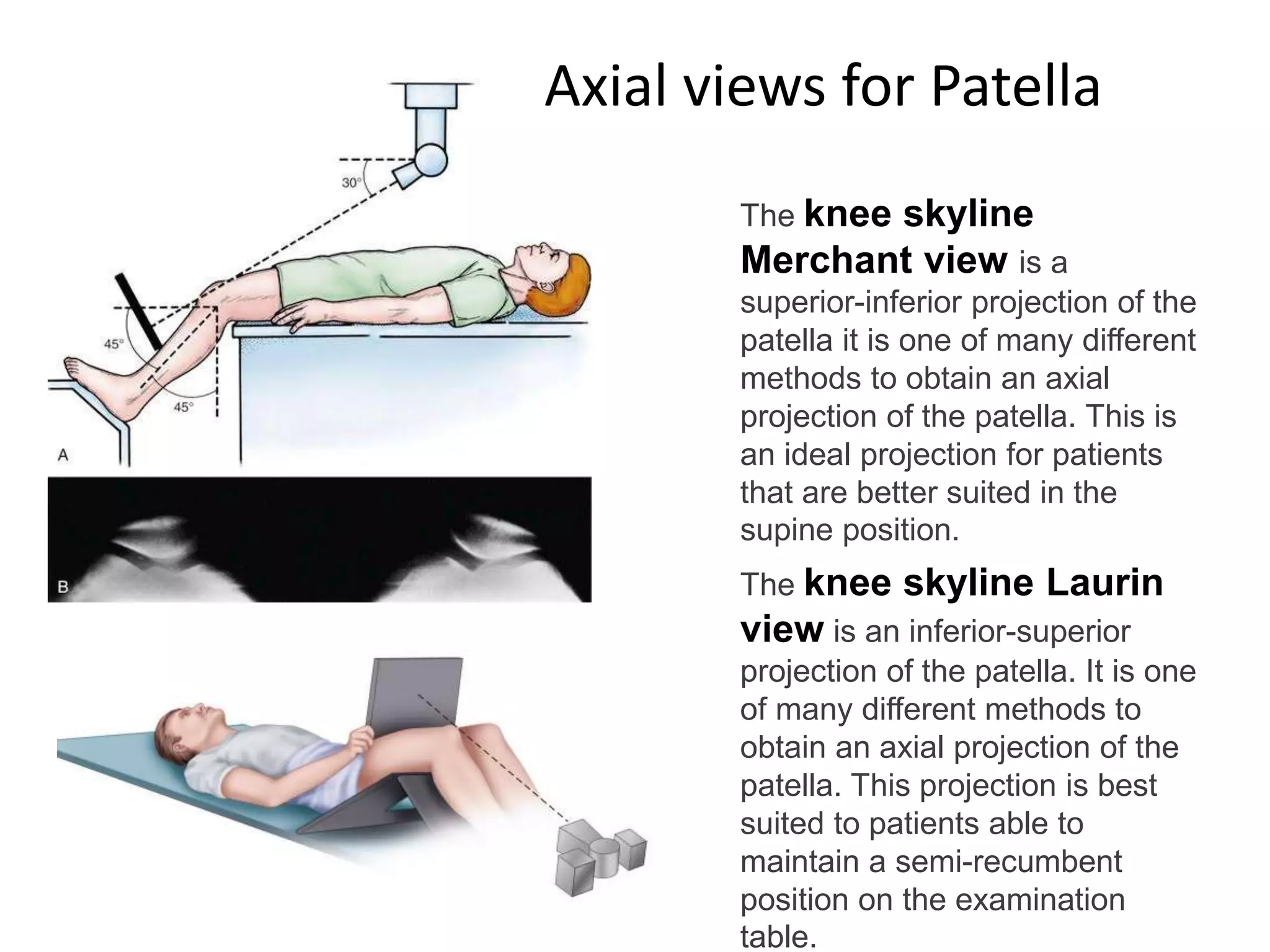 Patella dislocations | PPTX