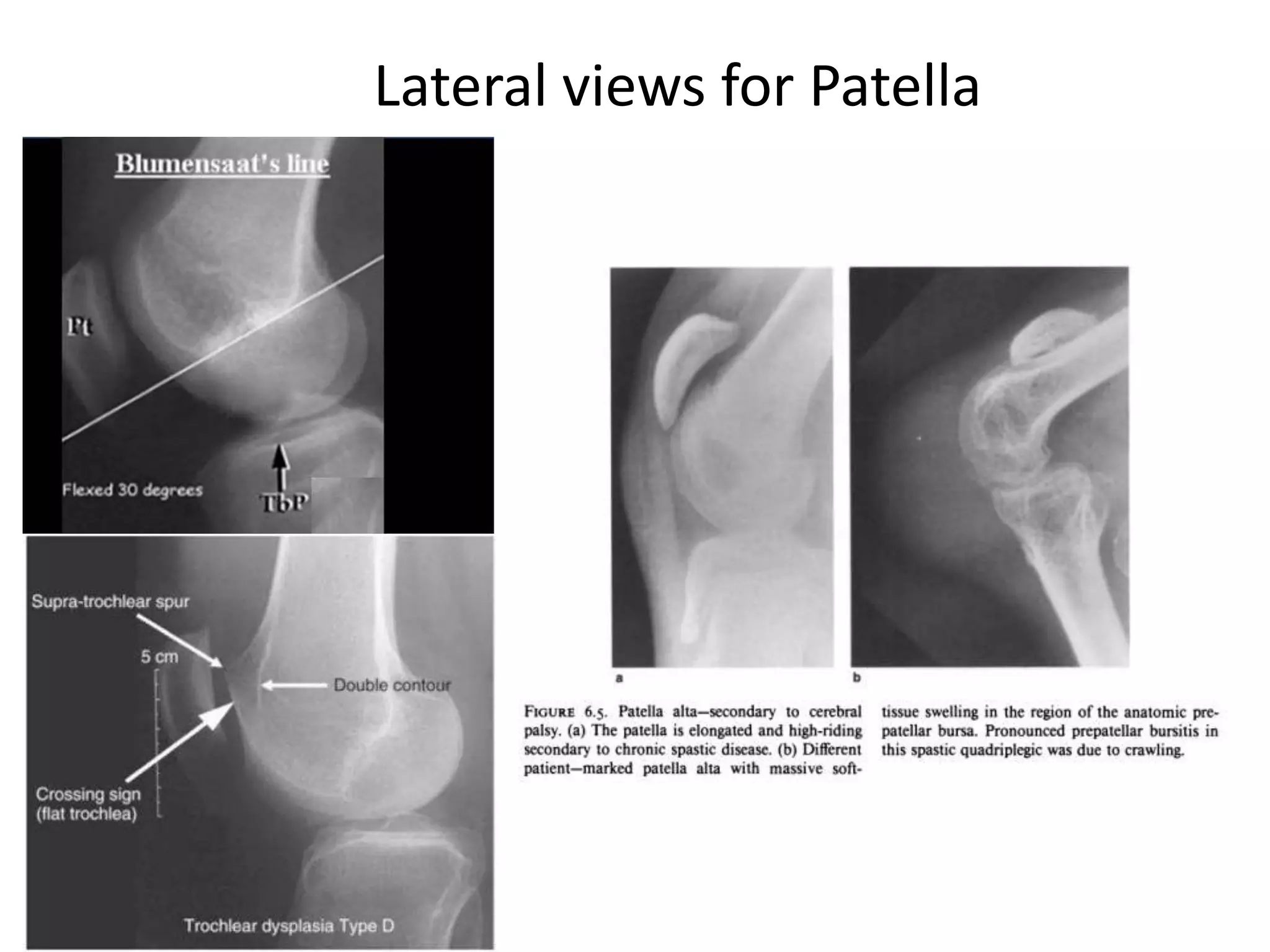 Patella dislocations | PPTX