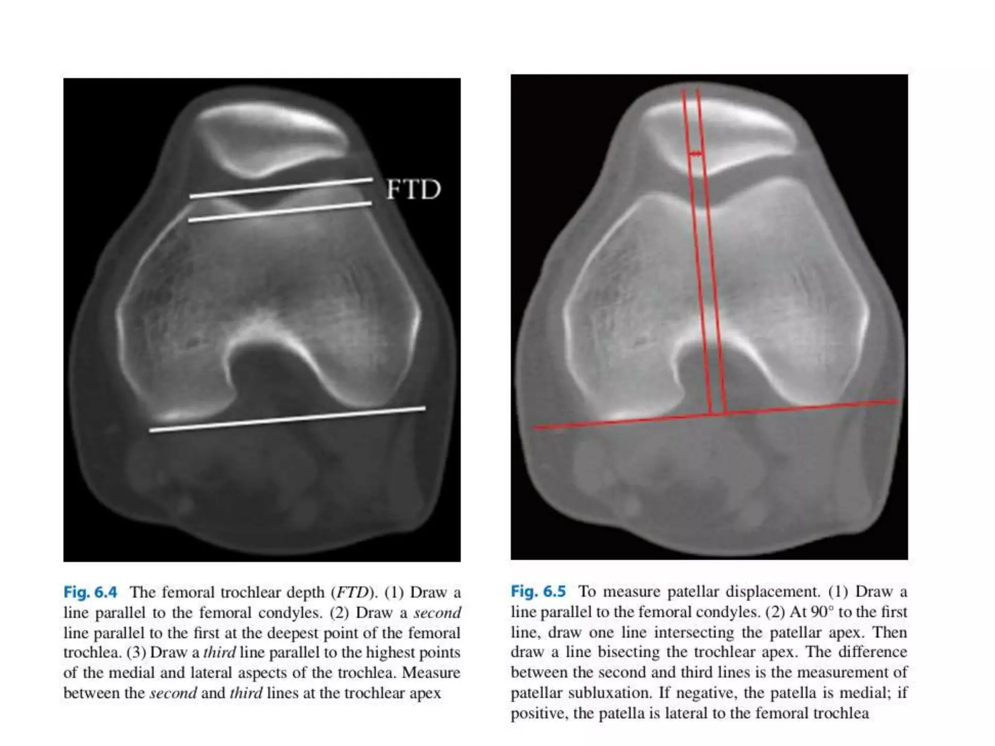 Patella dislocations | PPTX
