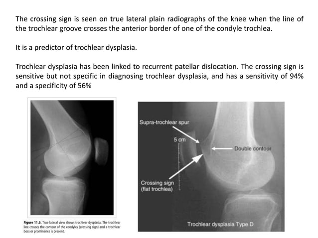 Patella dislocations | PPTX
