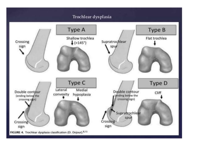 Patella dislocations | PPTX