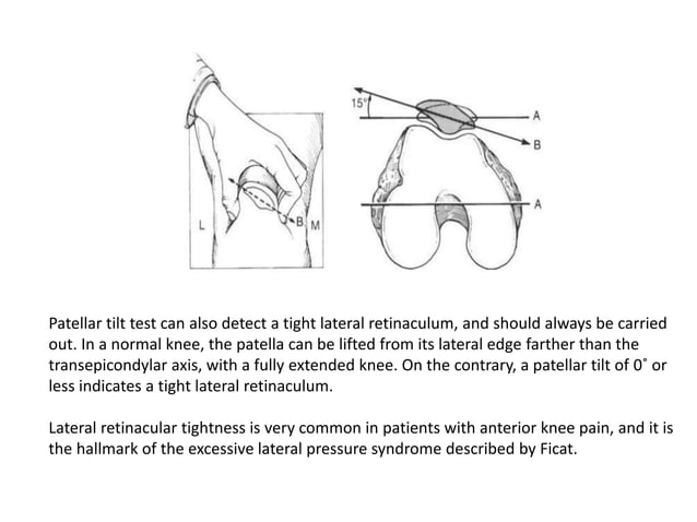 Patella dislocations | PPTX