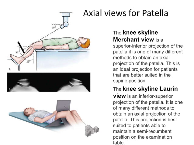Patella dislocations | PPTX