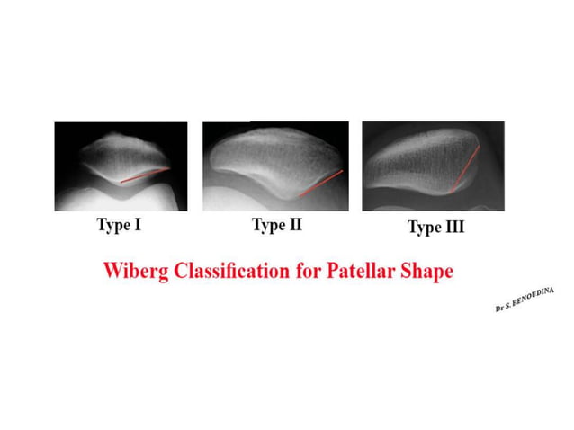 Patella dislocations | PPTX